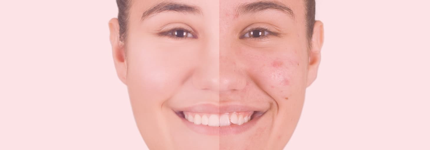 Traitement couperose laser - joue, visage, nez, rosacée prix - Centre 95