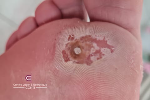 Traitement verrue laser - Verrue plantaire, main - Val d'Oise