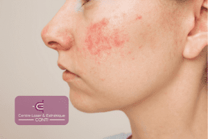 Traitement couperose laser - joue, visage, nez, rosacée prix - Centre 95