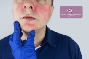 Traitement couperose laser - joue, visage, nez, rosacée prix - Centre 95