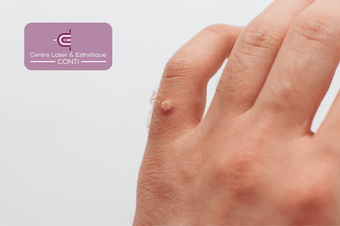 Traitement verrue laser - Verrue plantaire, main - Val d'Oise